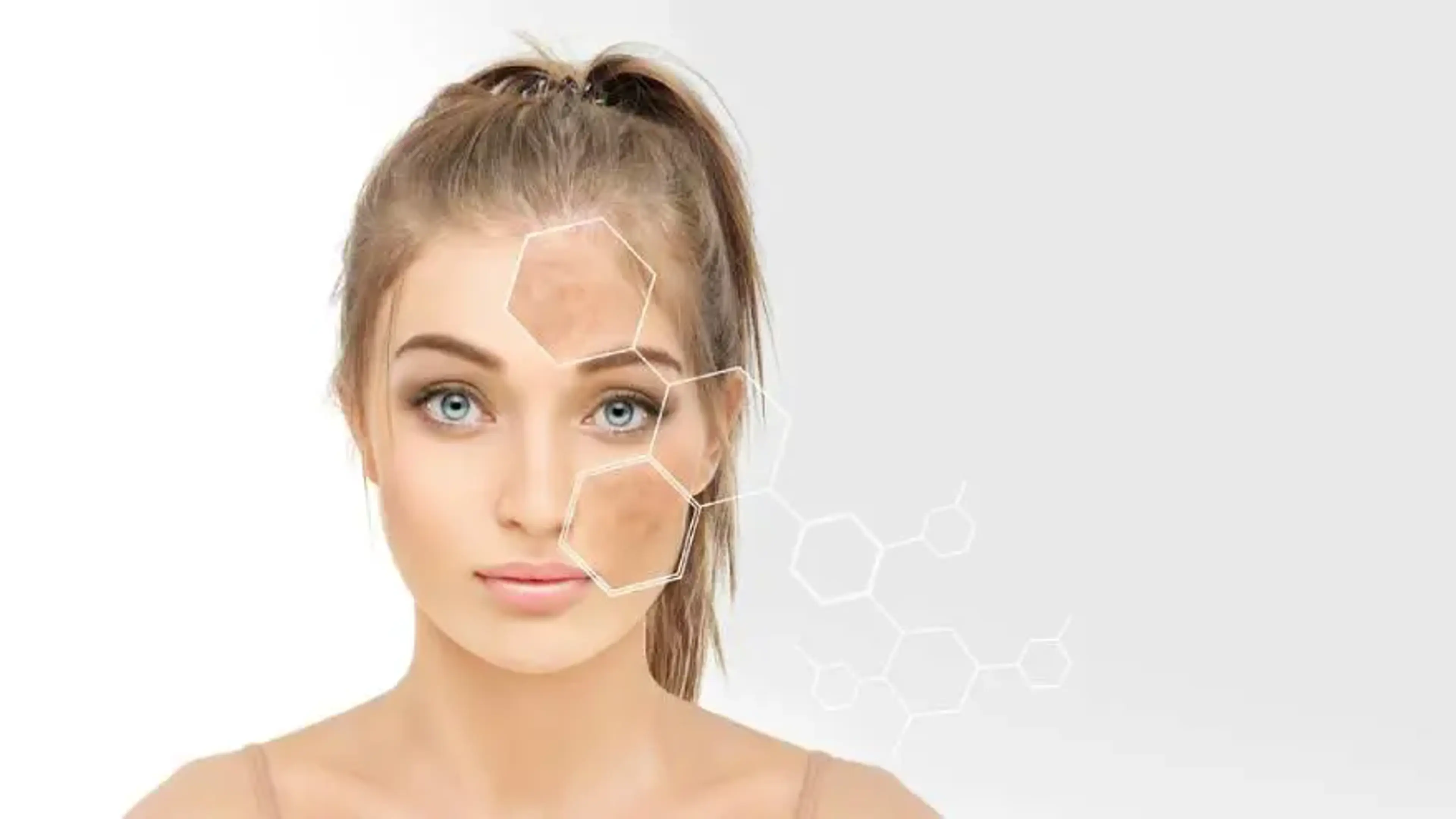 Articles | Laser Treatments for Hyperpigmentation: Fast, Effective Solutions